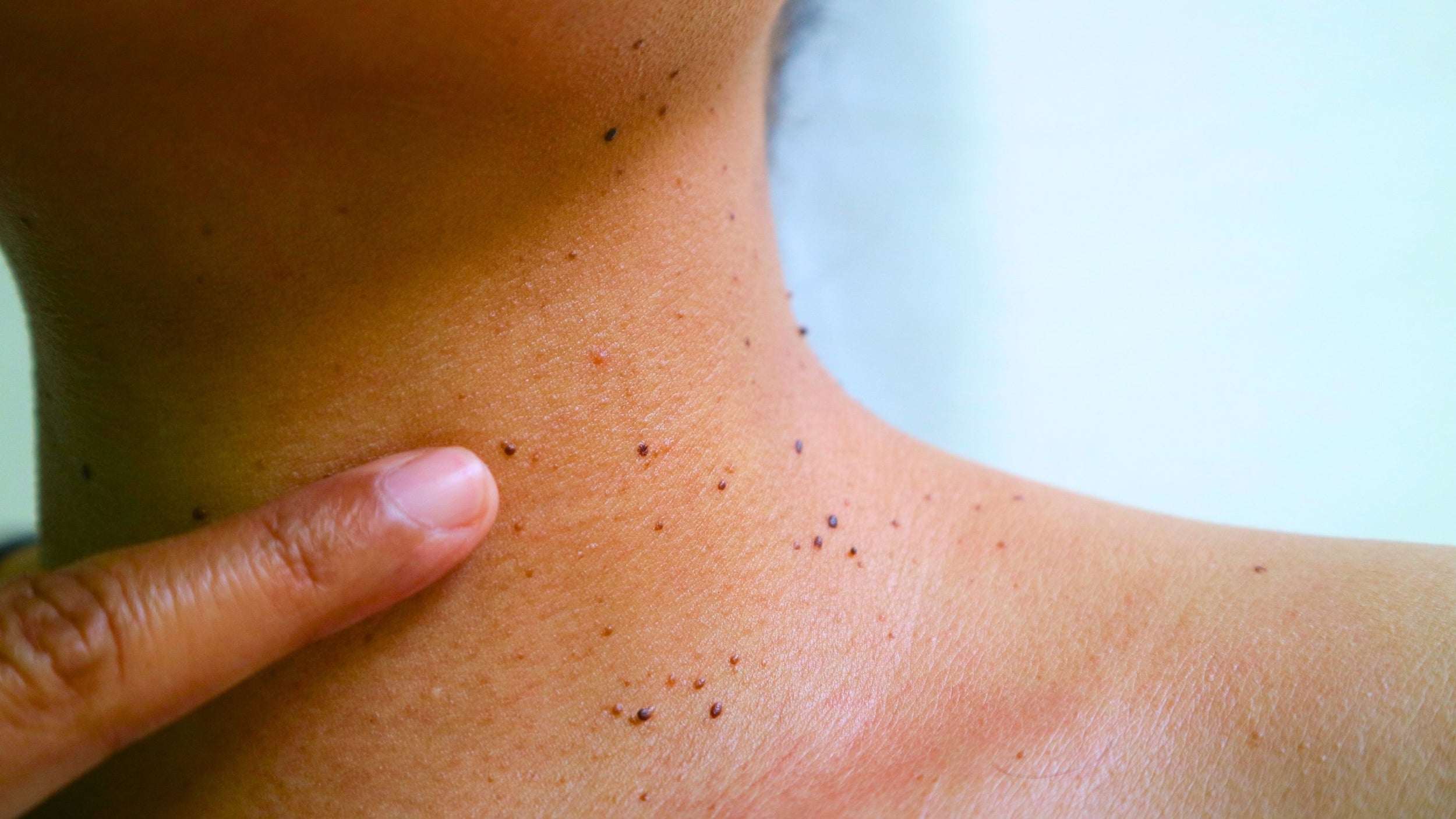 How to Treat Skin Tags on Black Skin - www.iknowskincare.com